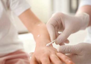 How to Treat Bed Bug Bites